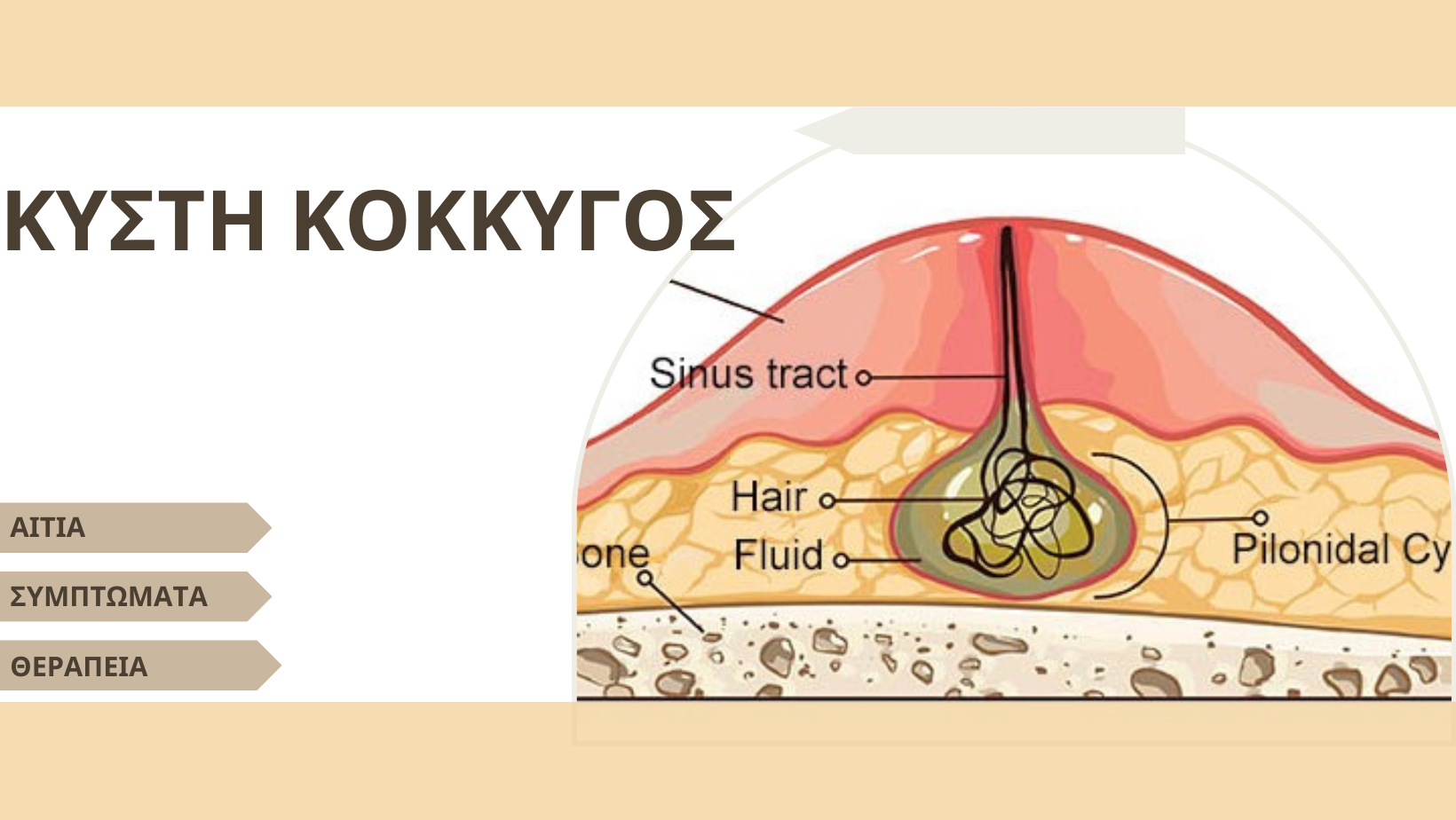 Pilonidal Cyst Symptoms And Treatment Traumacare Pilonidal Cyst Symptoms And Treatment Traumacare