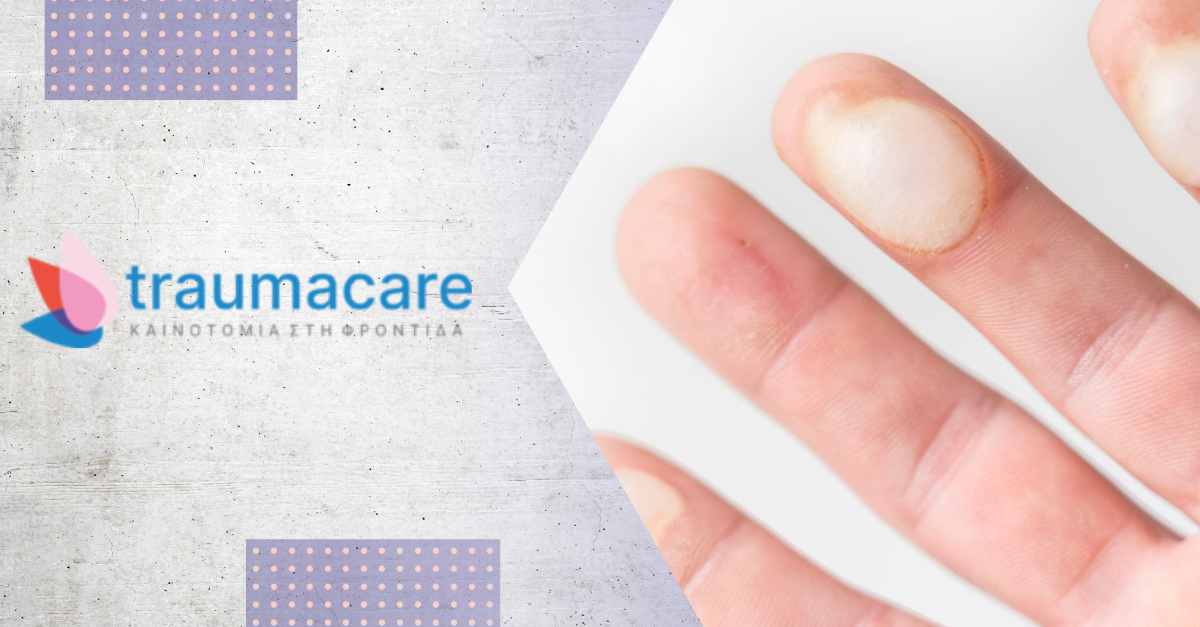 What Do We Put on A Burn? Tips for Burn Relief and Treatment - Traumacare